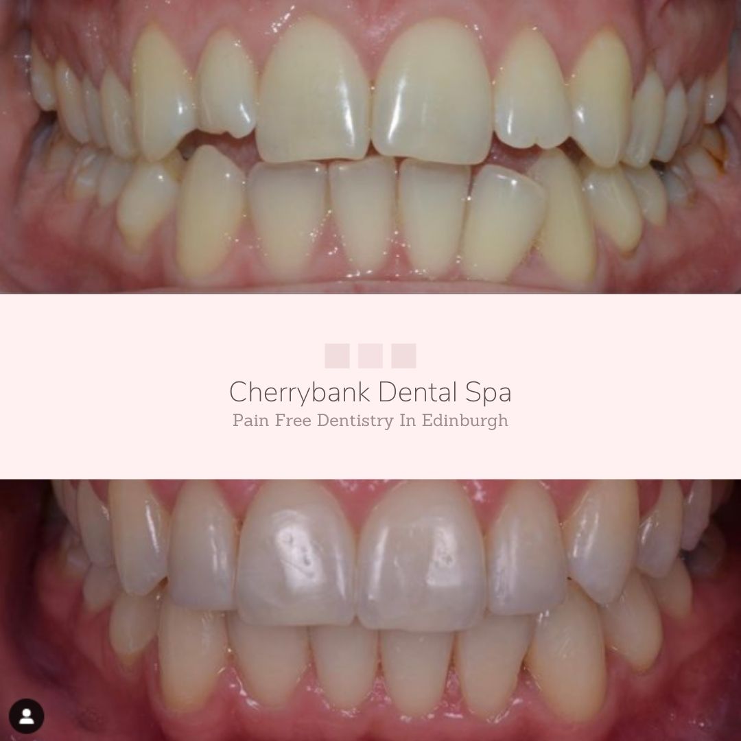 Invisalign Clear Aligners Edinburgh | Cherrybank Dental Spa